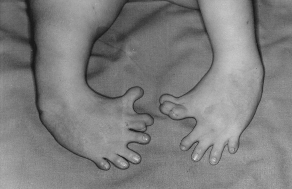 The first Thalidomide birth occurred in Germany - LifeScienceHistory.com