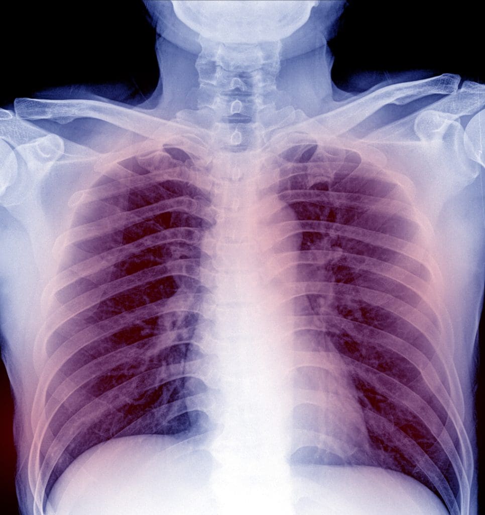 Cases of pneumonia detected in Wuhan, China were first reported to the ...