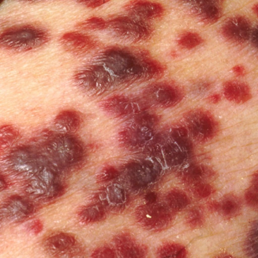 Human herpesvirus 8 (HHV-8), a causative agent for Kaposi's sarcoma ...