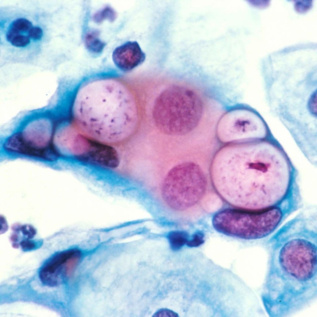 Bethesda System Conference developed system for standardized Pap smear ...