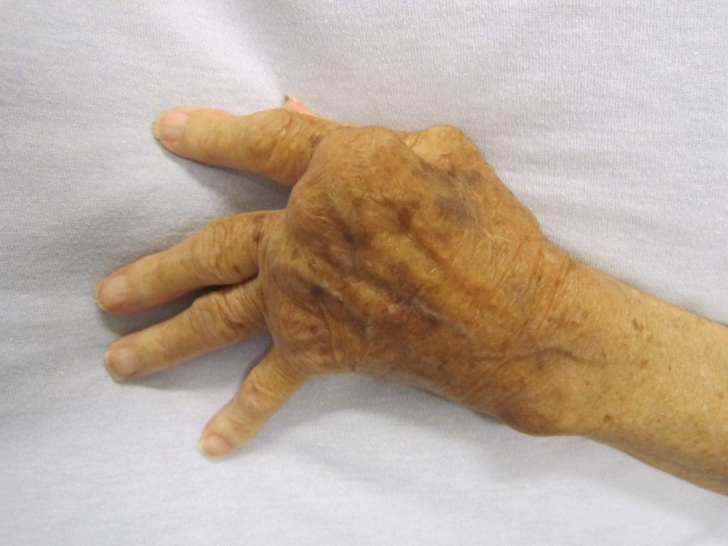 Rheumatoid Arthritis Gene Was Discovered 2516
