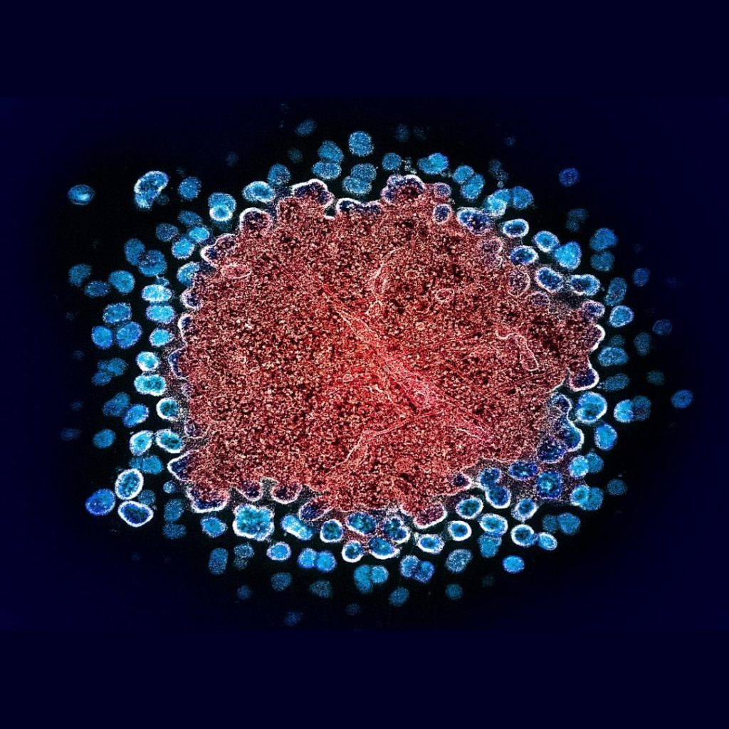 The CDC revised its definition of AIDS to include all HIV-infected ...