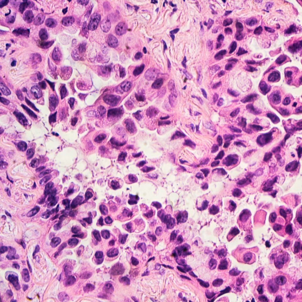 Winship Cancer Institute awarded prestigious Lung Cancer SPORE grant ...
